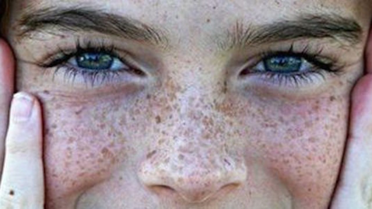 Sólo el 5% de la población mundial tiene pecas - Billiken