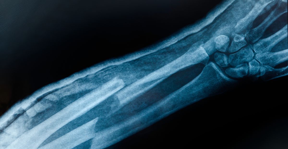 La ciencia de la fractura: ¿cómo se arregla un hueso roto? - Billiken